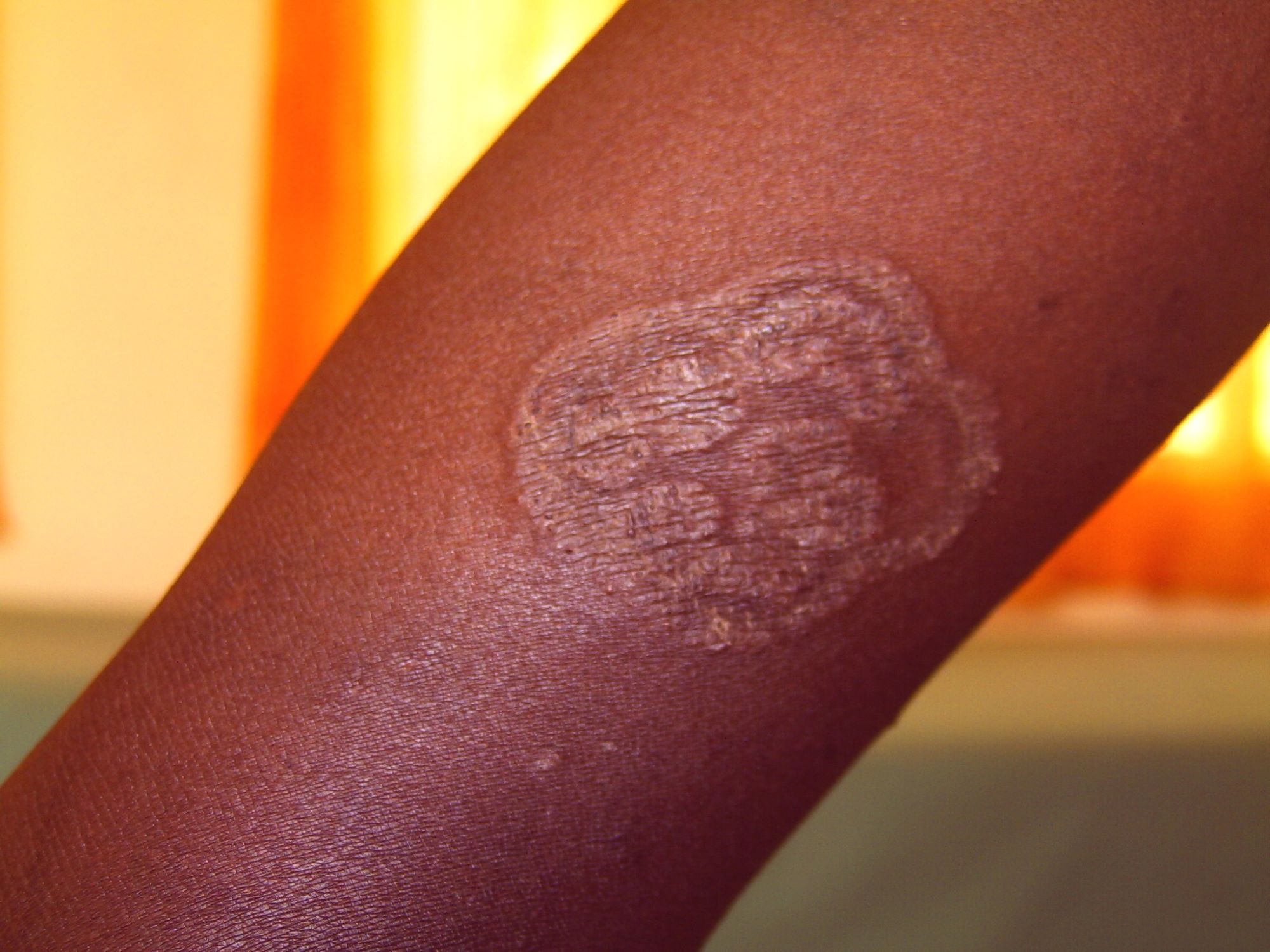 LABOPART - Nannizzia gypsea