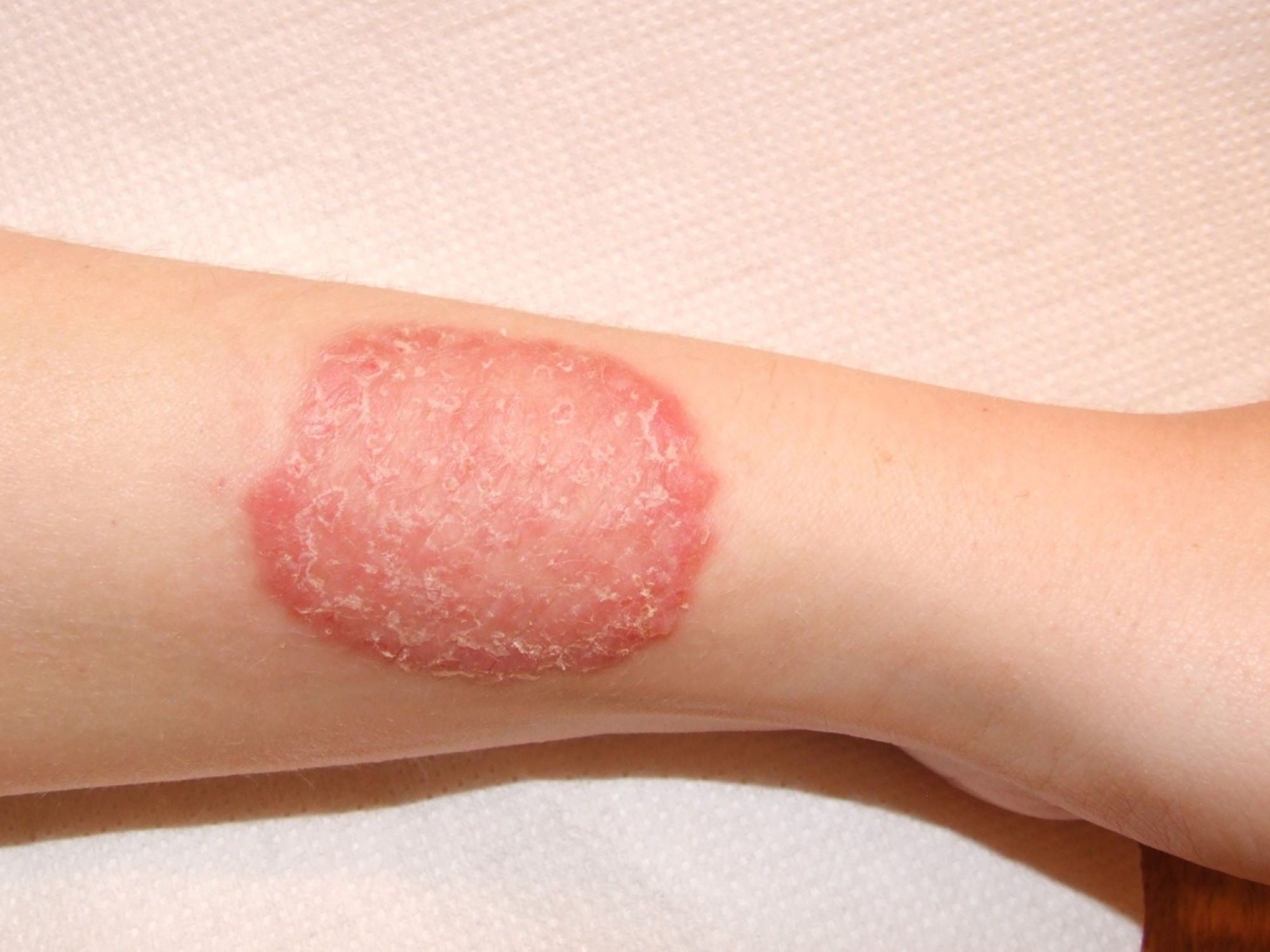 LABOPART - Trichophyton mentagrophytes